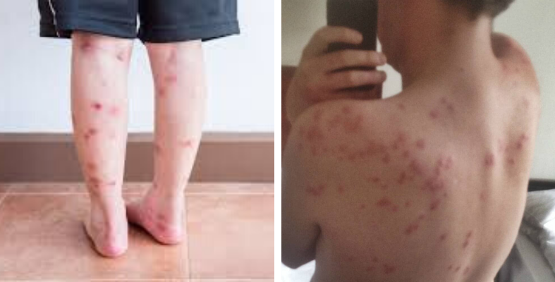 5 Tanda Korang Telah Diserang 'Pepijat' - No. 1 Paling Tak Percaya ...